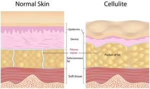 Cellulite Treatment in NYC | Manhattan Dermatology Specialists